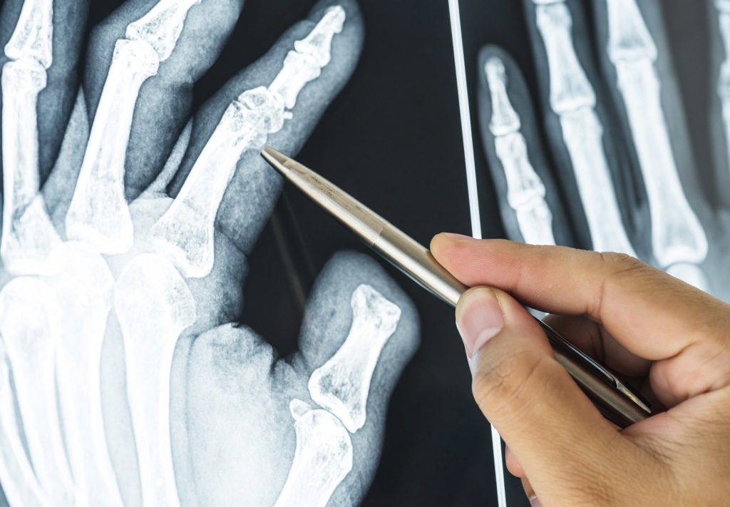 Trigger Finger - Sound Hand and Orthopedics